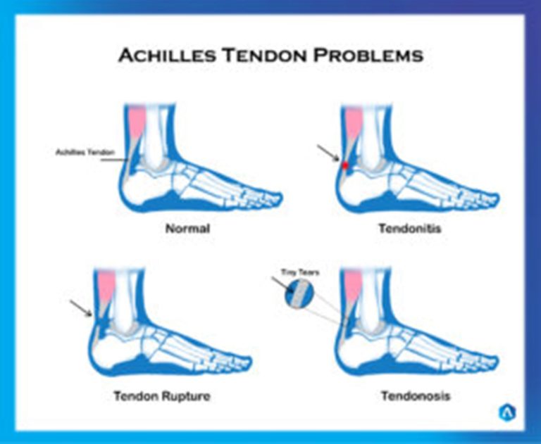 Achilles Pain – Crown Medical Orthotics