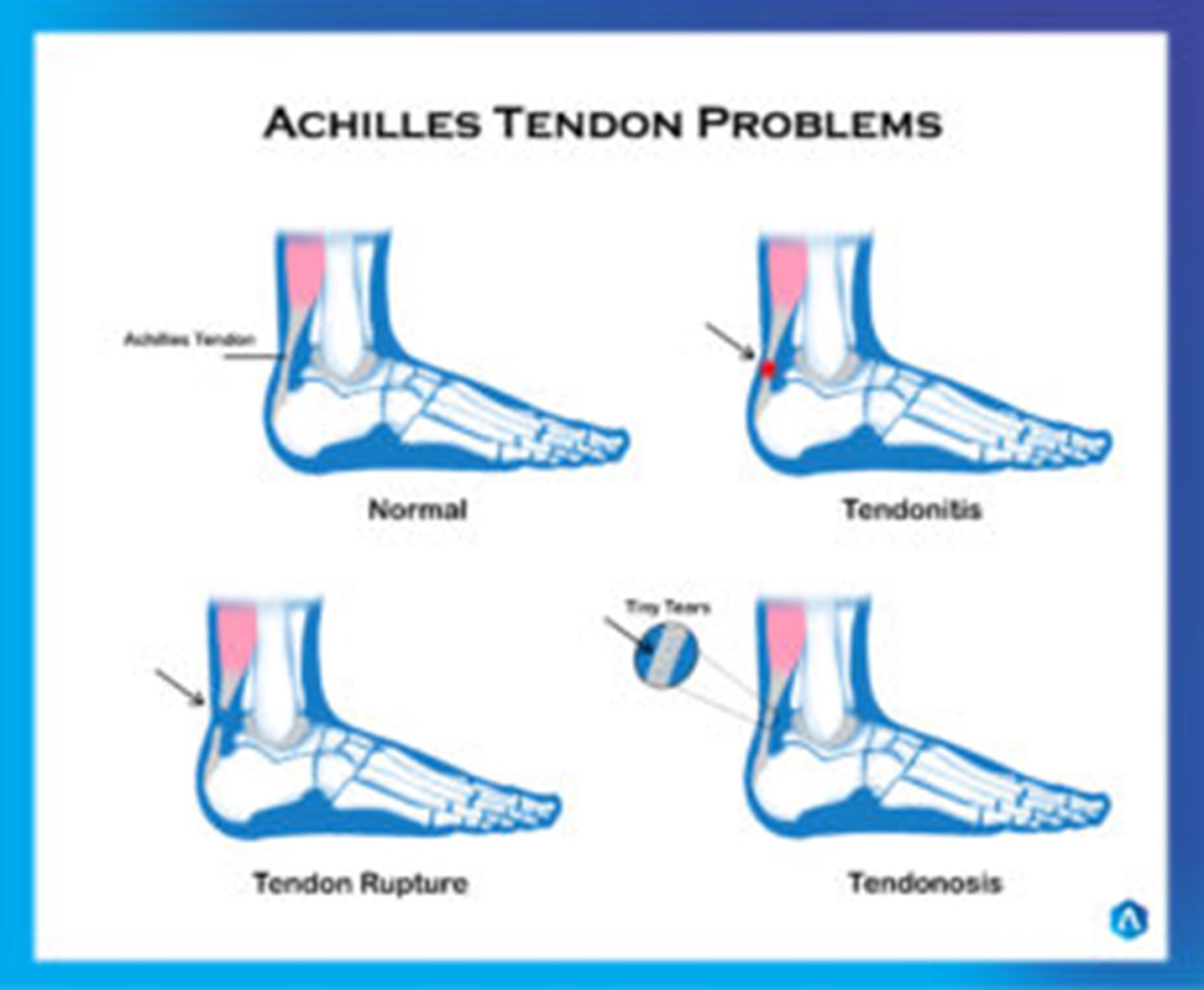 Achilles Pain – Crown Medical Orthotics