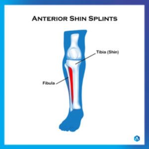 Shin Splints – Crown Medical Orthotics